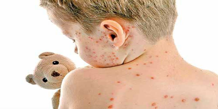 Diez datos que no sabías del sarampión - El Salmantino